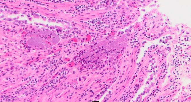 Yersiniosis NSW 2022