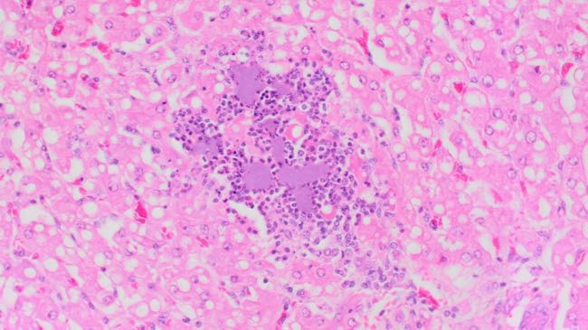 Yersiniosis NSW 2022