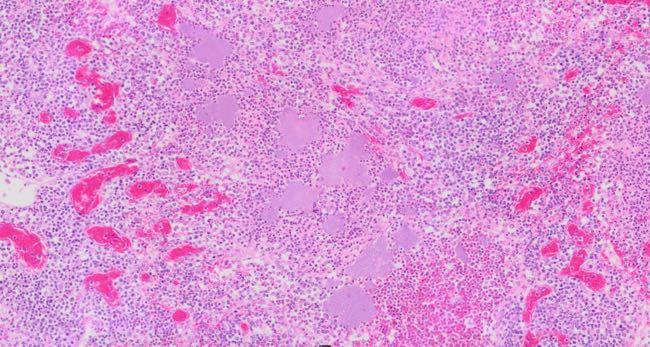 Yersiniosis NSW 2022