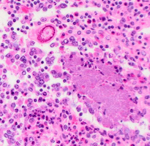 Yersiniosis NSW 2022