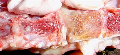 Vertebral abscesses